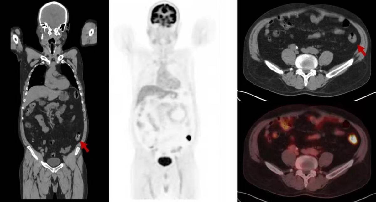 PET-CT检查大揭秘_诊断_SUVmax_代谢