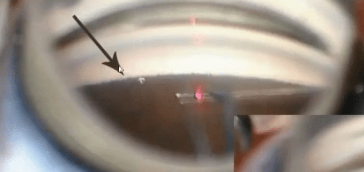 专题回顾 |开往春天——GATT 与 PCP 青光眼手术研讨会（上）_中国医师协会_iTrack_临床