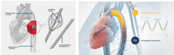 人工心脏5——一文浅析短期PVAD（下）_Impella_主动脉_导管