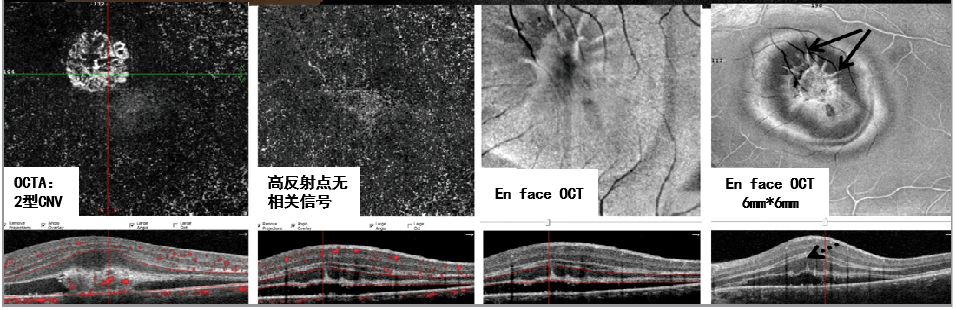 “Pitchfork 征”— 2型CNV之OCT新启示_retina