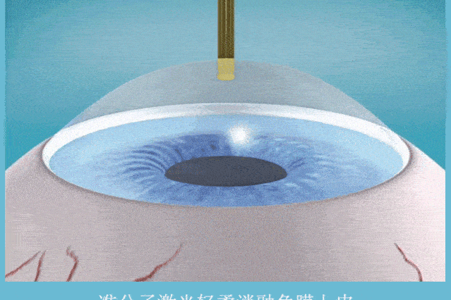 友华普惠丨Trans—PRK全激光_蔡司_手术_视觉