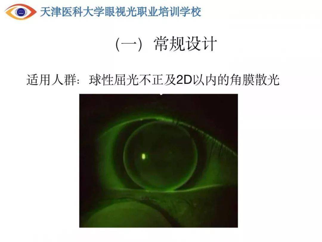 【眼视光】 RGP镜片病例分析_角膜
