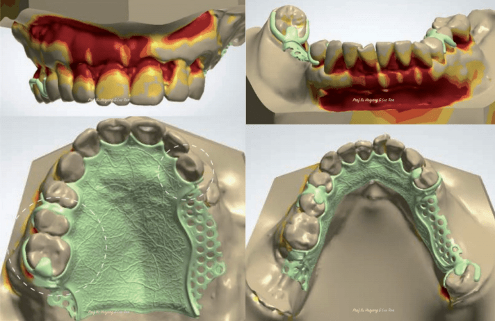数字化RPD是整合式修复学的最佳切入点——于海洋教授_义齿