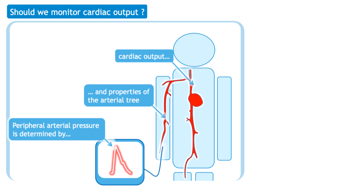 PiCCO在ICU中的应用_进行