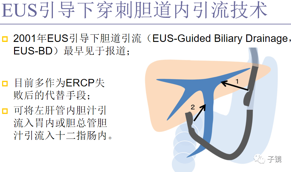 “超声内镜（EUS）”学习笔记（2020广东省中医消化年会）_支架