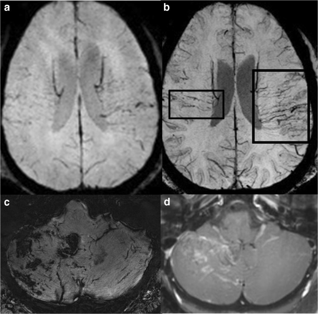 Neuroradiology：7T MRI 临床应用示例_显示