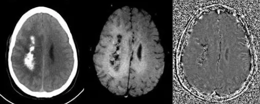 MR功能成像 | SWI（1）_加权