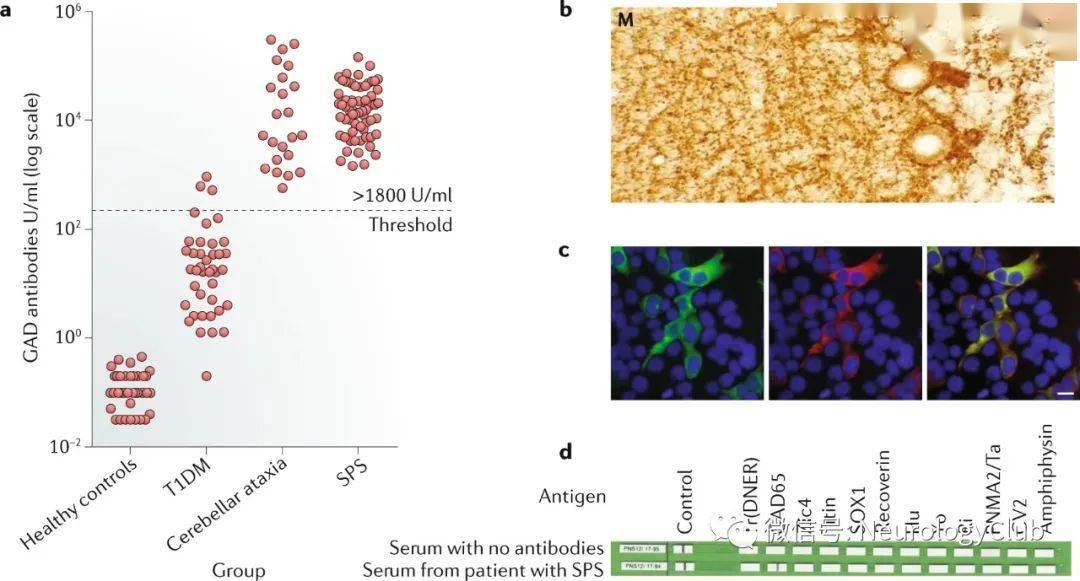 神经综述：谷氨酸脱羧酶（GAD）抗体与神经系统疾病_综合征