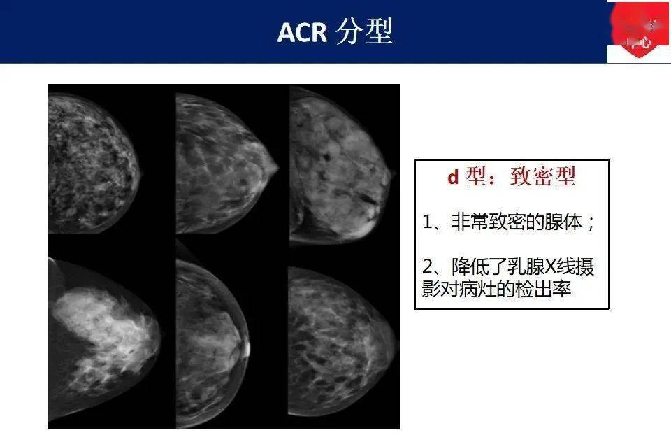 最新版乳腺X线 BI-RADS 分类解读_检查