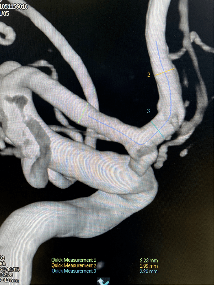 送无阻、顺必达—Phenom™ 27微导管在前循环远端血管中的应用_支架_Flex_血流