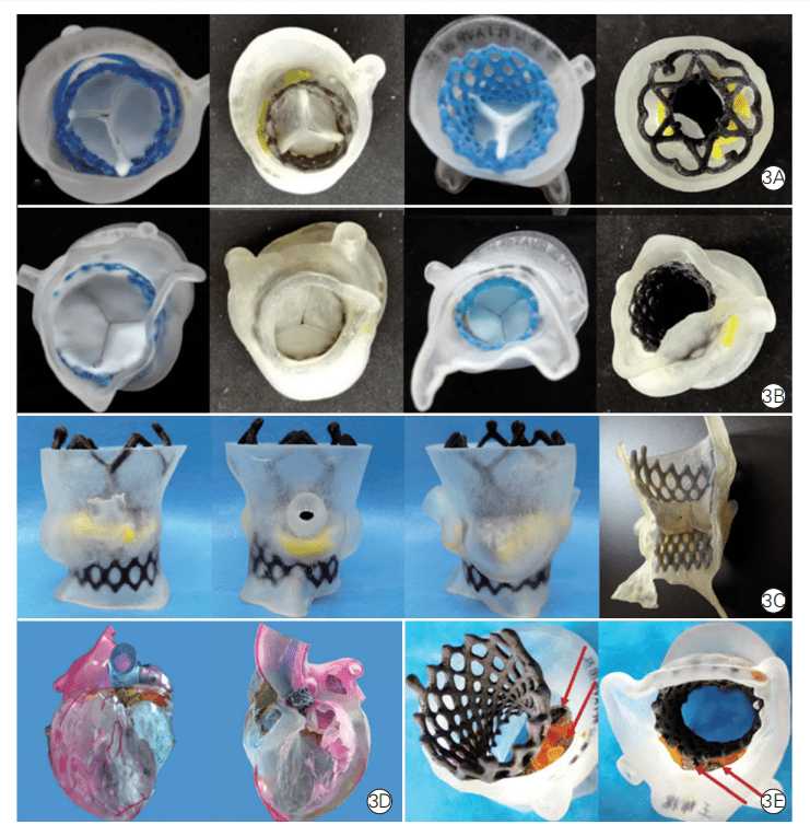 3D打印，可助力TAVR手术！全国多中心868例患者研究_min_vs_mGy