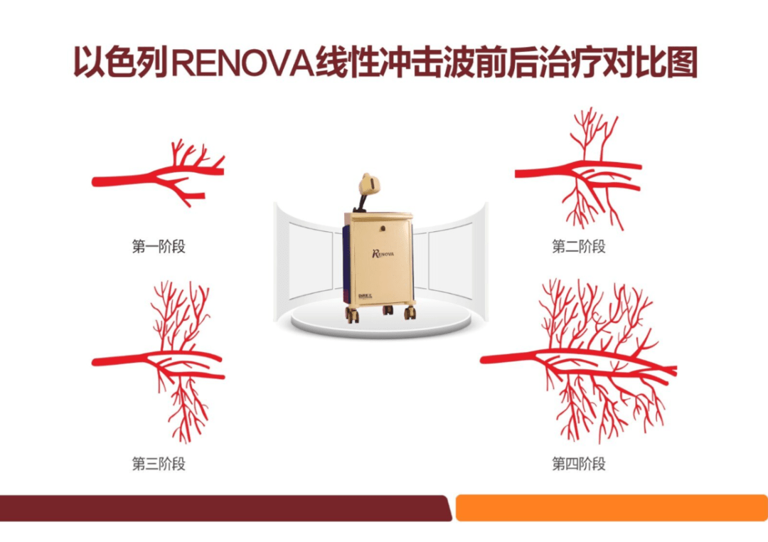 杭州阳痿早泄患者的福音：Renova低能量冲击波治疗找回性福_阴茎_血管_疗程