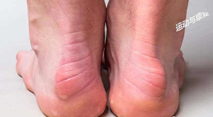 哈格伦德综合征（Haglund's Disease) – 跑者的恶梦_畸形_脚后跟_鞋子