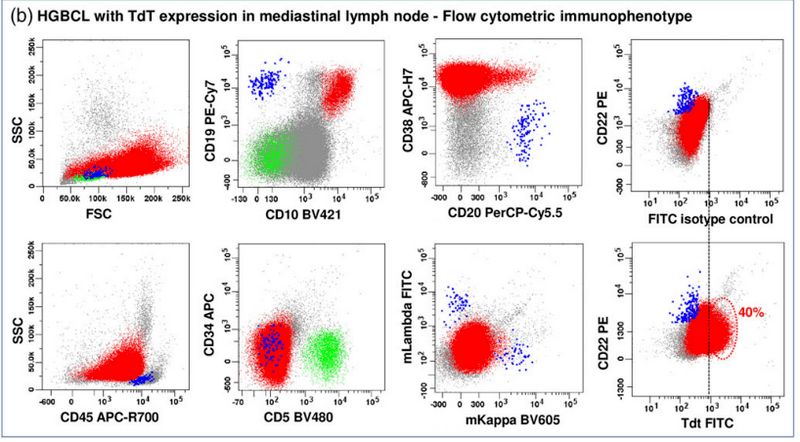 肿瘤B细胞的TdT+，你会将其诊断为B-ALL吗？_淋巴结_显示_分析