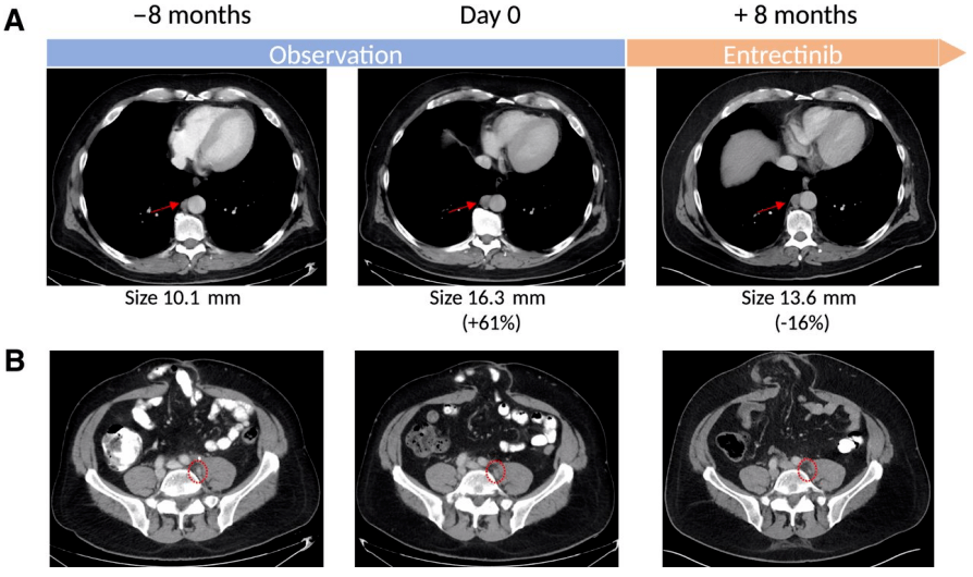不抛弃不放弃！RAS/BRAF野生型、MSS结直肠癌更易检出ROS1融合，有靶药！_基因_样本_患者