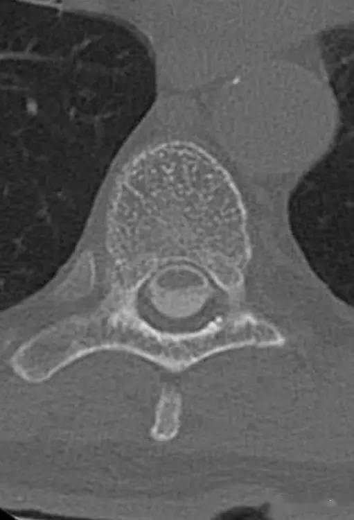 手术刀征：背侧蛛网膜网带_the_cord_of