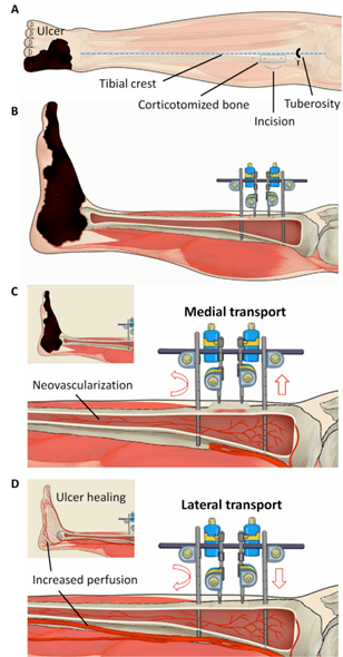 广西医科大一附院关于胫骨横向骨搬移治疗糖尿病足的又一重磅文章发表_中心_临床_足部