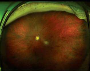 精彩疑例丨白内障术后虹膜新生血管急性发作一例_检查_hemi-CRVO_手术