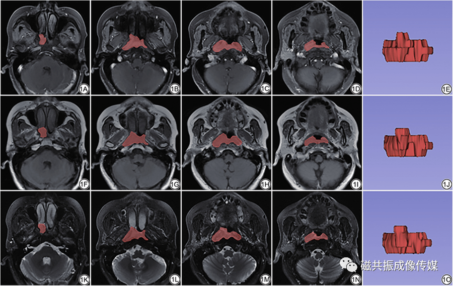 基于多参数MRI影像组学联合临床影像特征预测鼻咽癌肿瘤细胞增殖活性_成像_磁共振_研究生