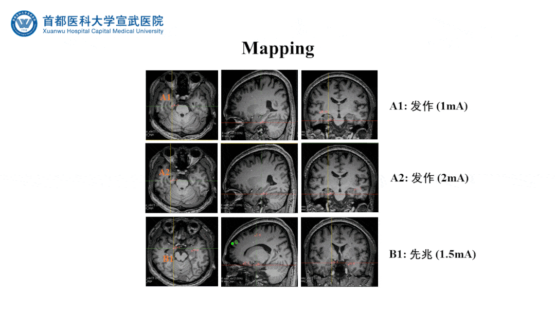 华科在线｜专访宣武医院乔梁：手术机器人无死角操作优势与SEEG经验_电极_应用