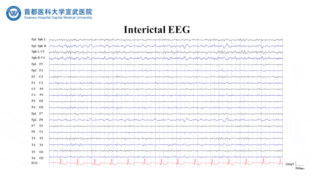 华科在线｜专访宣武医院乔梁：手术机器人无死角操作优势与SEEG经验_电极_应用