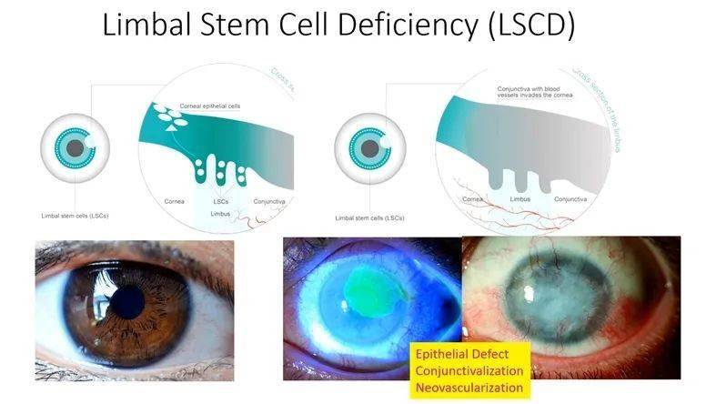 治疗角膜缘干细胞缺乏引起的角膜盲的新方法——Corneal RegenTouch_上皮_组织_疾病