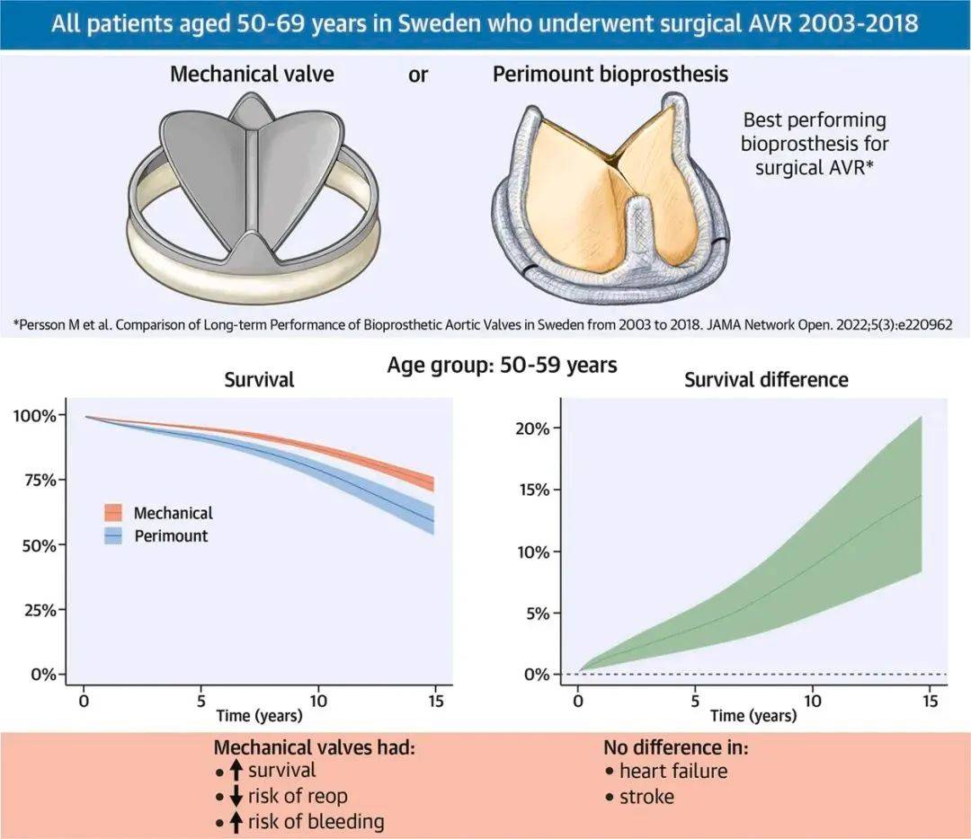 50~69岁主动脉瓣病换瓣手术，机械瓣优于生物瓣！瑞典注册研究_患者_瓣膜_循环