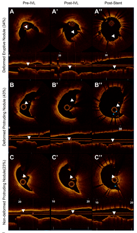 冲击钙化，前沿速递——Shockwave IVL治疗钙化结节病变具有长期安全性和有效性！_患者_研究_vs